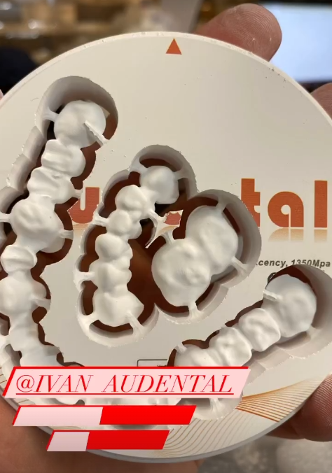 What Do You Think About Porcelain Fused to Zirconia Crowns (PFZ)？